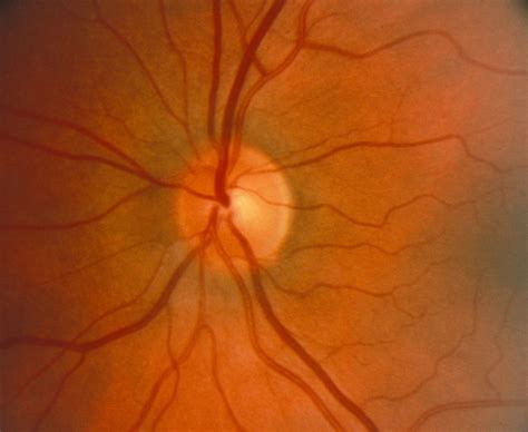 Optic Disc Pallor Coms Grading