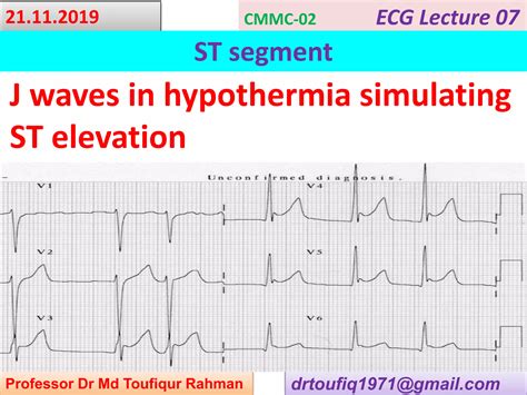 Ecg St Segment Ppsx