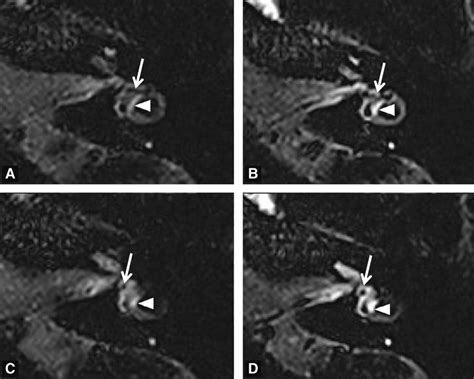 Comparison Of Perilymphatic Signal Intensity And Visualization Of Download Scientific Diagram