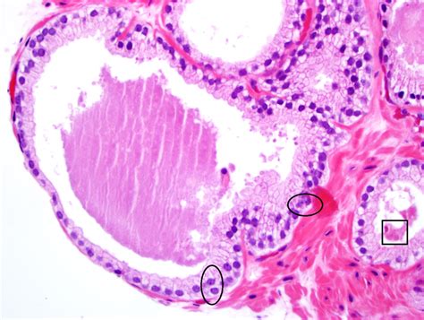Pathology Outlines Atrophy