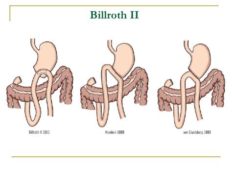 Billroth 2