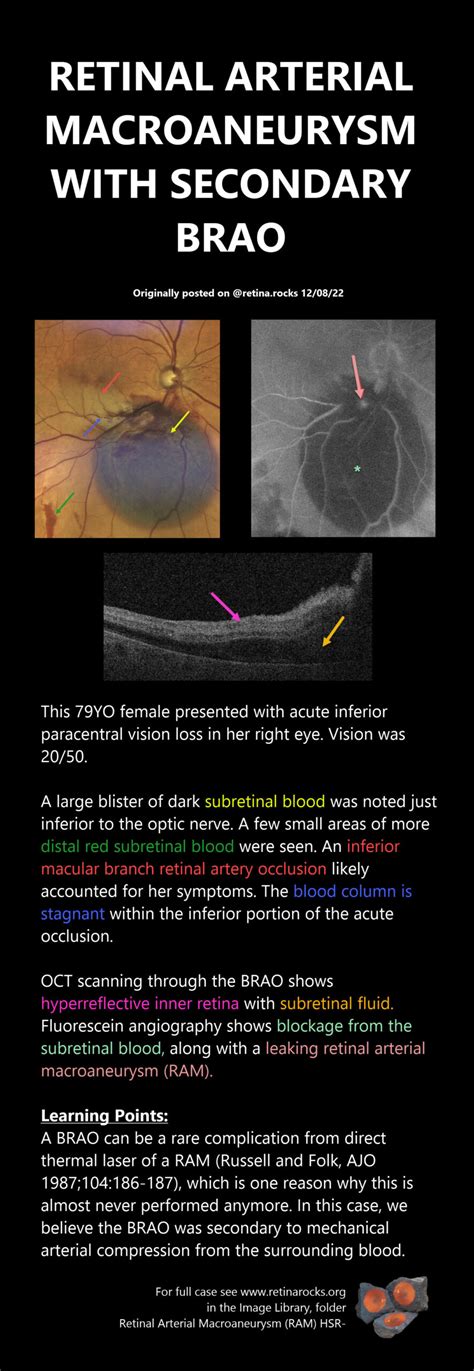 Retinal Vascular Disorders Misc Retinal Arterial Macroaneurysm Ram Retina Rocks
