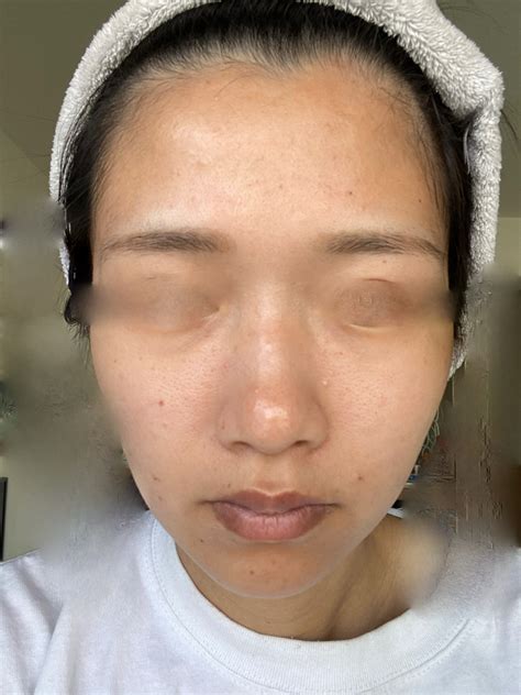 의사에게 물어보세요 피부가 많이 더러워 강남언니 1등 성형수술and피부시술 정보앱