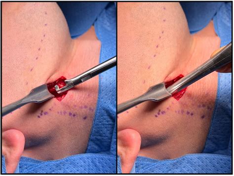 Minimally Invasive Cervical Styloidectomy In Stylohyoid Syndrome Eagle
