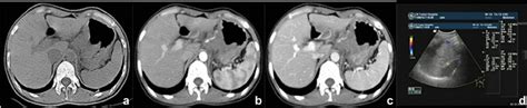 T4 Gastric Cancer In Cardia And Gastric Fundus A C Ct Scanning The