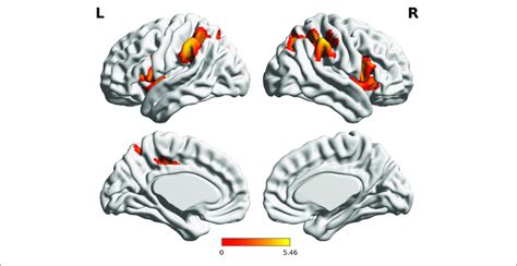 Decreased Functional Connectivity From Brocas Area Homologue In Download Scientific Diagram