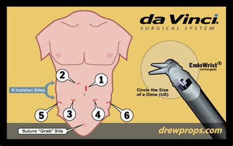 Radical Prostatectomy Incision
