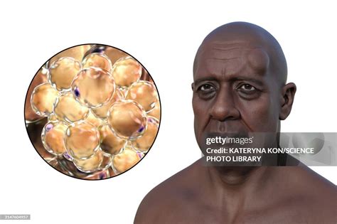 Lipoma On A Mans Forehead Illustration High Res Vector Graphic Getty