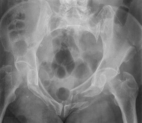 Pelvic Fracture X Ray Learningradiology Pelvic Avulsion Fractures
