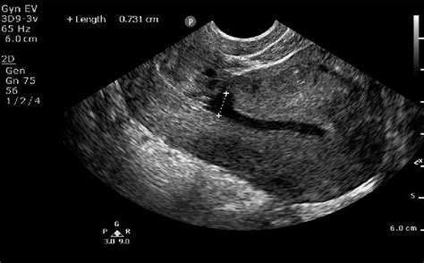 자궁의 제왕절개 흉터 결함 자궁내시경적 치료 Hysteroscopic Repair Of Cesarean Scar