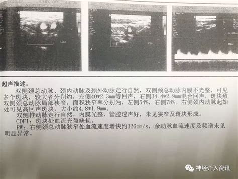 山西省心血管病医院脑血管病中心颈动脉慢性闭塞再通个案报道 脑医汇