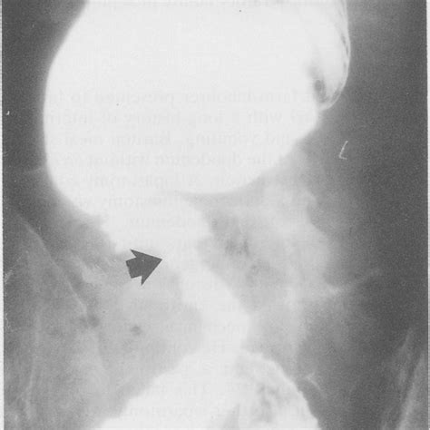 Barium Meal In Case I Showing A Dilated Duodenum Proximal To An