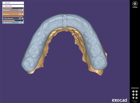 In House 3d Printing Of Occlusal Splint For Patient With Parafunctional Habits And Premature