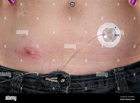 Abscess On The Abdomen In A 41 Year Old Diabetic Female Patient At The