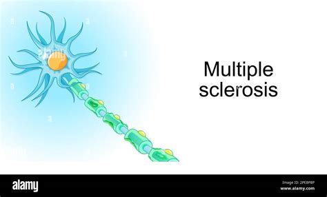 Multiple Sclerosis Demyelinating Disease Autoimmune Disease Vector Illustration For Poster Or