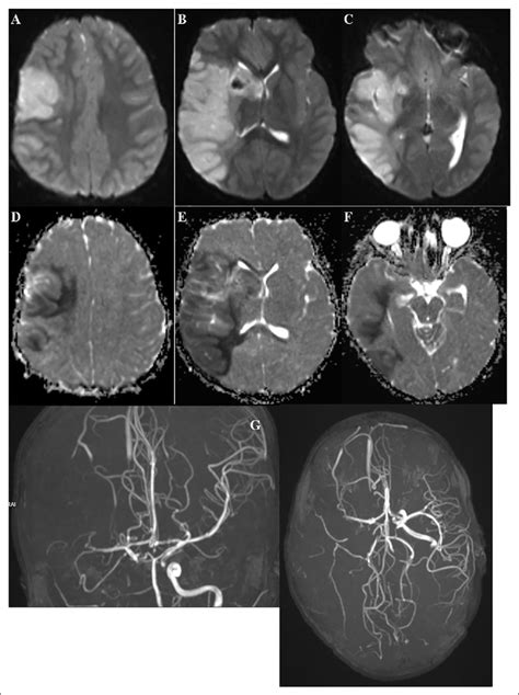 Images A C Diffusion Weighted Imaging Dwi Images D E Adc Maps