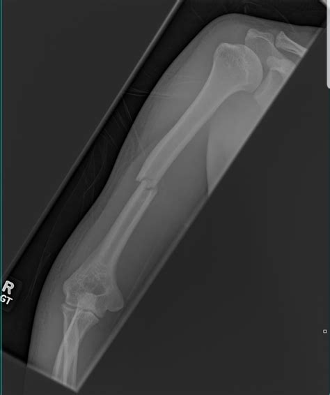 I Am At Week 7th Aftwr Humerus Shaft Fracture Splint Was Off After 3 Weeks And Functional Brace