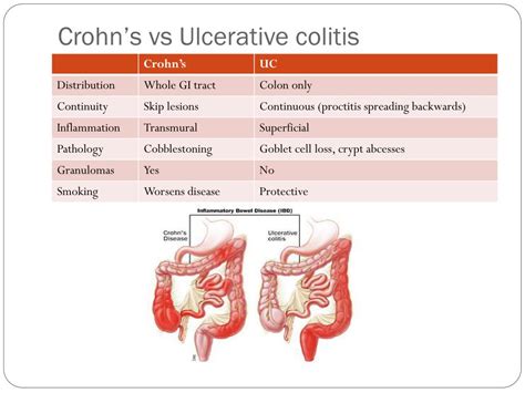 Ppt Ibd Powerpoint Presentation Free Download Id2120318 Ppt Ibd Powerpoint Presentation Free Download Id2120318