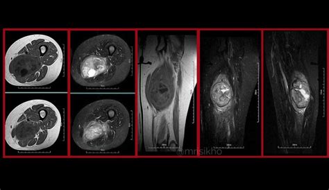 Mri Sikho On Linkedin Myosarcoma Openmri Timemedical Clinicalmri Rm Radiology Mritech…