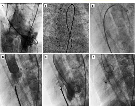 Figure 1 From Nit‐occlud Lê Vsd Coil Versus Duct Occluders For Percutaneous Perimembranous
