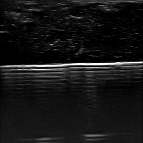 Needle Tracking Liver N18 Object Detection Dataset By Needle