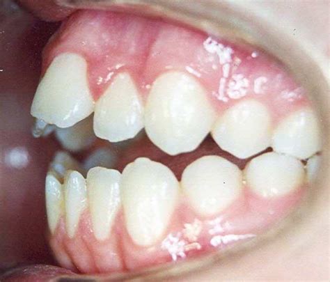 Class Iii And Open Bite Guidance And Treatment Ios