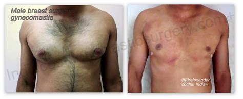 Cosmetic Plastic Surgeon Gynecomastia Male Breast Enlargement