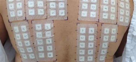 Patch Tests What Are They About Healthy Food Near Me