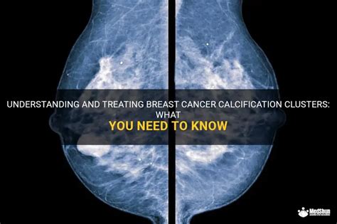 Understanding And Treating Breast Cancer Calcification Clusters What You Need To Know Medshun