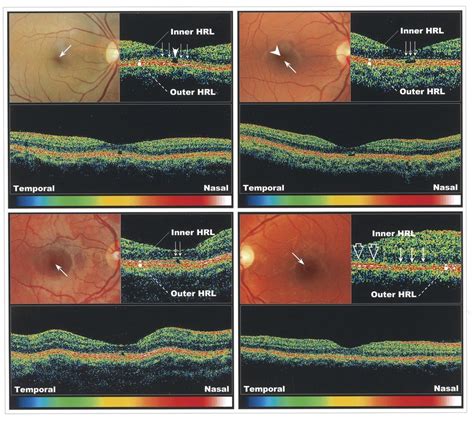 Solar Retinopathy Oct