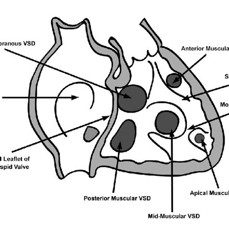 Operative Photograph Showing Proposed Incision A And Transverse