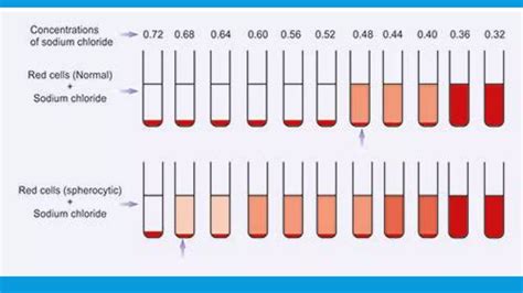 Osmotic Fragility Test Pptx