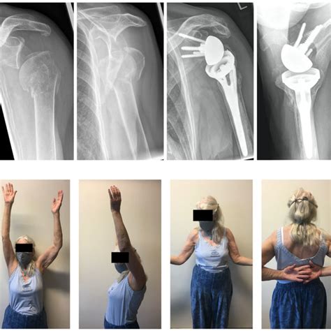 Clinical Scores With Regard To Head Split Fracture Pattern Types