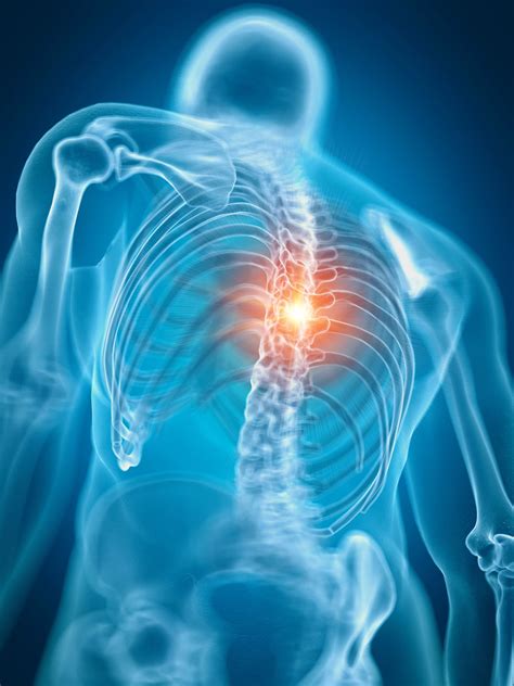 Spinal Cord Compression Askgulu