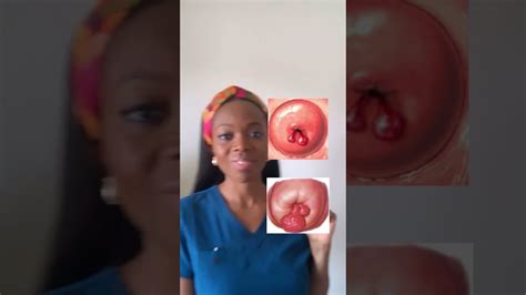 Cervical Polyp Removal Decoding Cpt Codes And What To Expect Sciencestream Blog