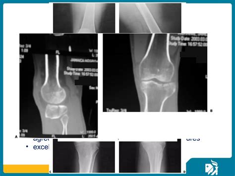 Proximal Tibial Fracture PPT