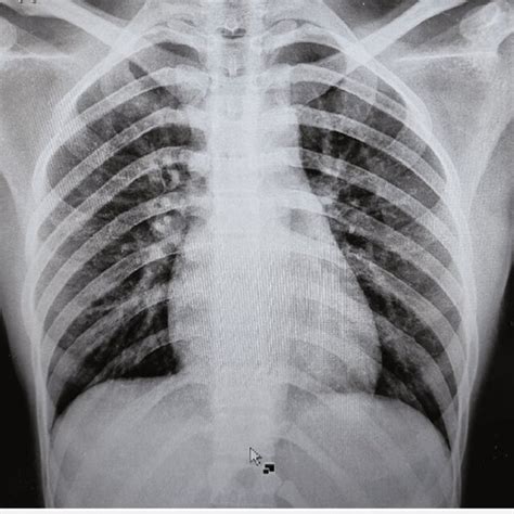 Chest Radiograph Pa View Showing Normal Lung Fields Except For A Few Download Scientific