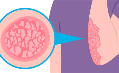 Pyoderma Gangrenosum Unraveling An Uncommon Skin Disorder