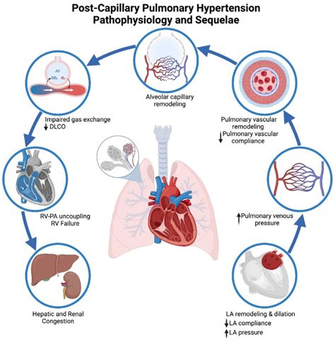 Post Capillary Pulmonary Hypertension Clinical Review Pmc