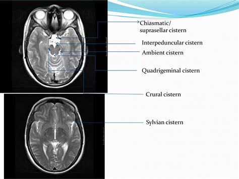 CSF Circulation Disorders PPTX