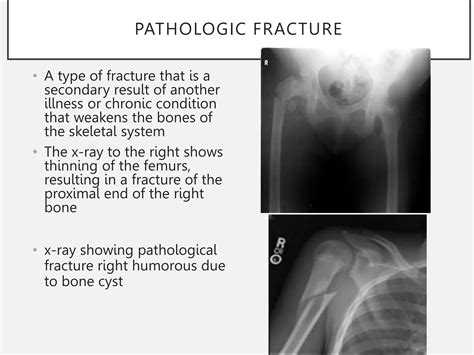 X Ray Diagnostics Of Fractures And Dislocationspptx