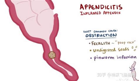 医学科普之阑尾炎 知乎