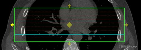 医学图像处理软件实战开发qt C Vtk 3qt医学软件 Csdn博客