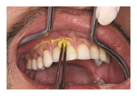 A Scraping And Root Smoothing B Smear With Tetracycline Download Scientific Diagram
