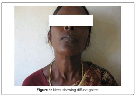 An Uncommon Skeletal Manifestation Of Graves Disease