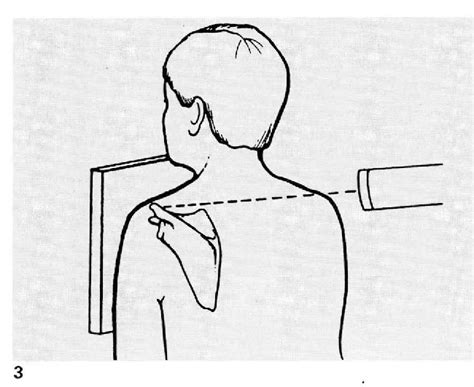 Figure 3 From Simple Radiographic Finding Of Subacromial Impingement Syndrome Semantic Scholar