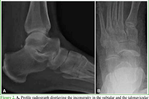 Figure 2 From Pure Medial Subtalar Dislocation Case Report And Literature Review Semantic