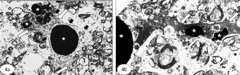 A B Electron Microscopy Using Reprocessed Formalin Fixed Material