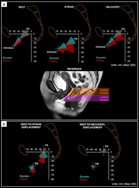 Vaginal Configuration And Displacement In The Anatomic Space Visual Download Scientific Diagram
