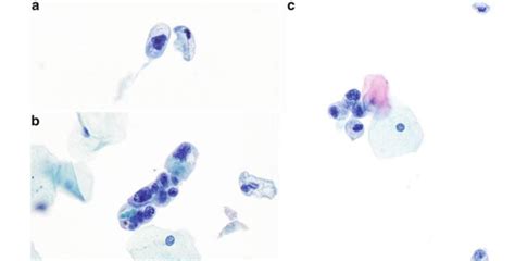 Exemple De Cellules Urothéliales Atypiques Avec Des Rapports Nc